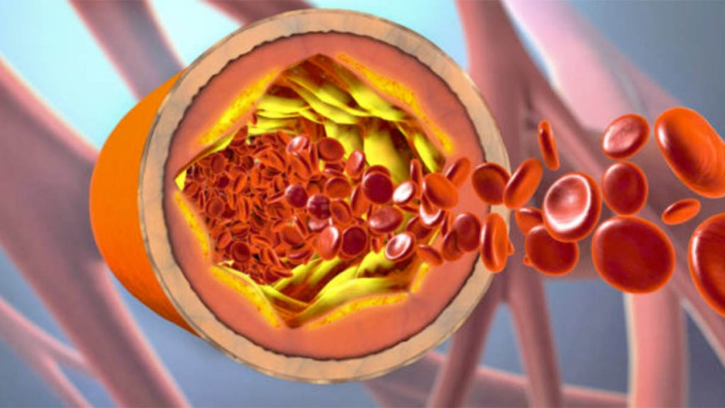 Kolesteroli I Lartë Tek Gratë - Si Ta Kuptoni Dhe Kujdesi Që Duhet Të ...