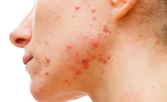 stafilokok - AgroWeb